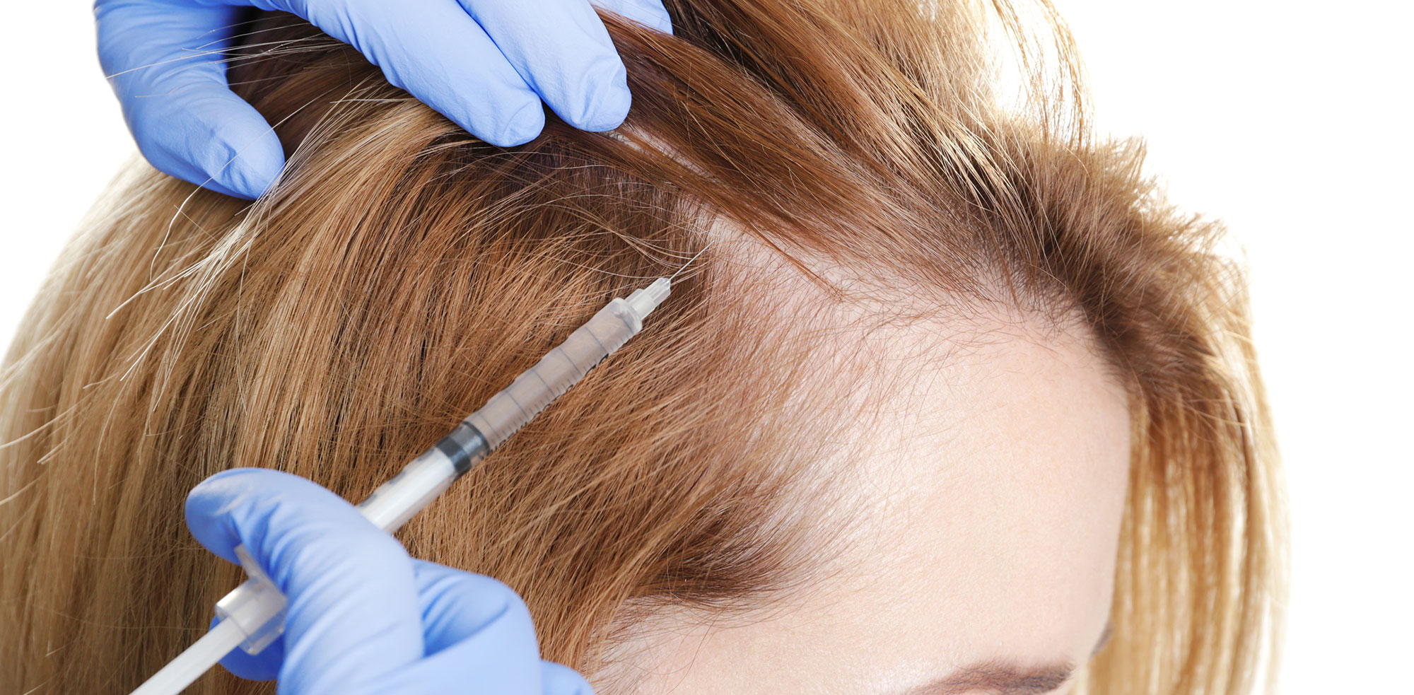 haarverlies-behandeling2 - DermaPuur